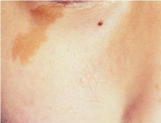 Blotchy Skin - Laser Treatments for Redness & Pigmentation - Sydney
