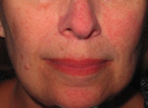 Blotchy Skin - Laser Treatments for Redness & Pigmentation - Sydney