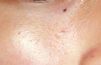 Q Switch Laser - Pigmentation & Birthmark Treatments