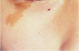 Q Switch Laser - Pigmentation & Birthmark Treatments