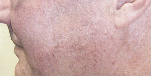 The Plethoric Face | uRepublic – Cosmetic Dermatology & Veins – Sydney ...